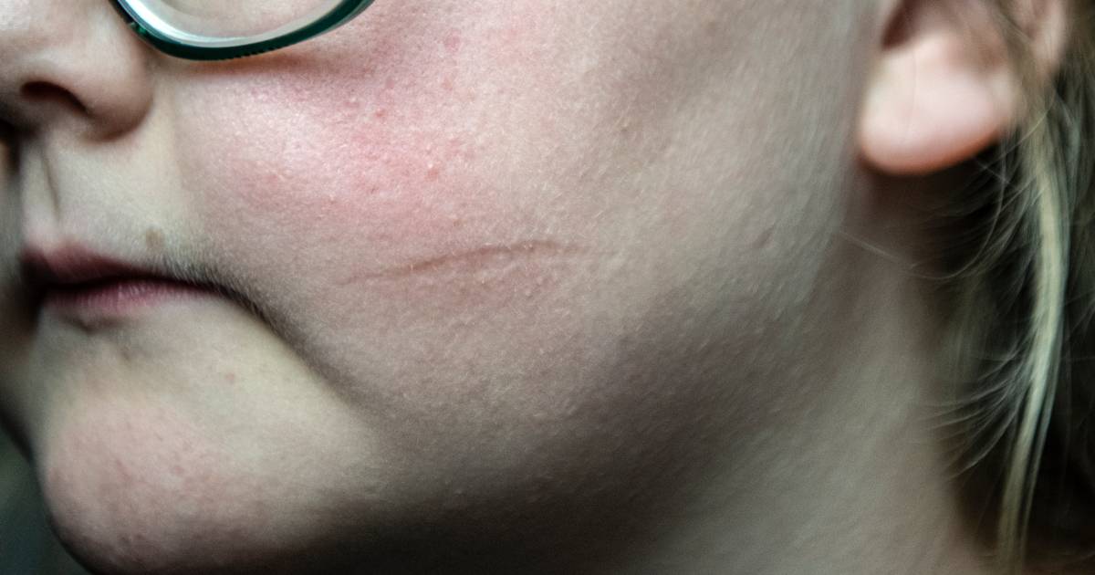 Onderzoek naar baby's die snijwond opliepen bij keizersnede ...