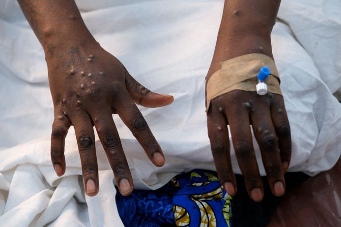 Eerste besmetting met nieuwe mpox-variant in Duitsland, oude variant ...