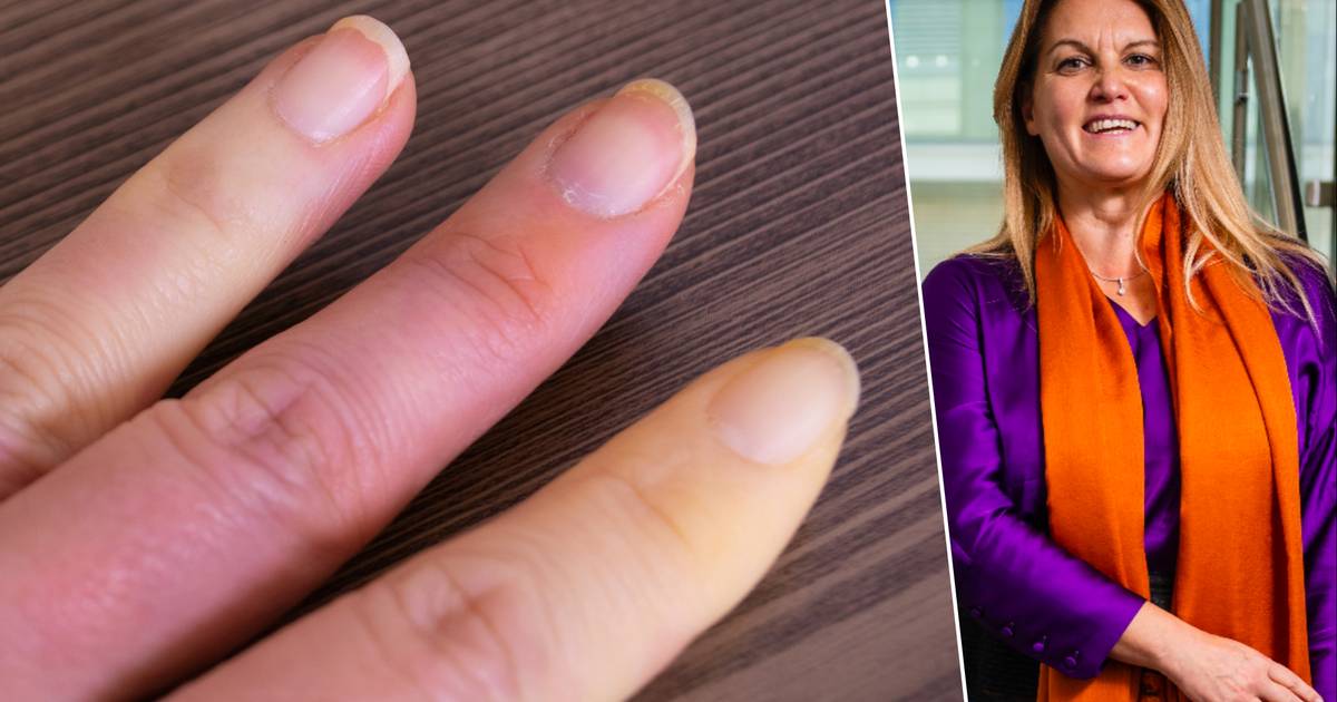 Plots last van witte vingers of tenen? Let dan op: “Het kan een voorloper zijn van deze zeldzame ...