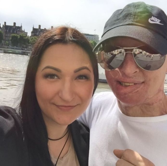 Daniel raakte zwaar verminkt nadat vriendin bijtend zuur over hem ...