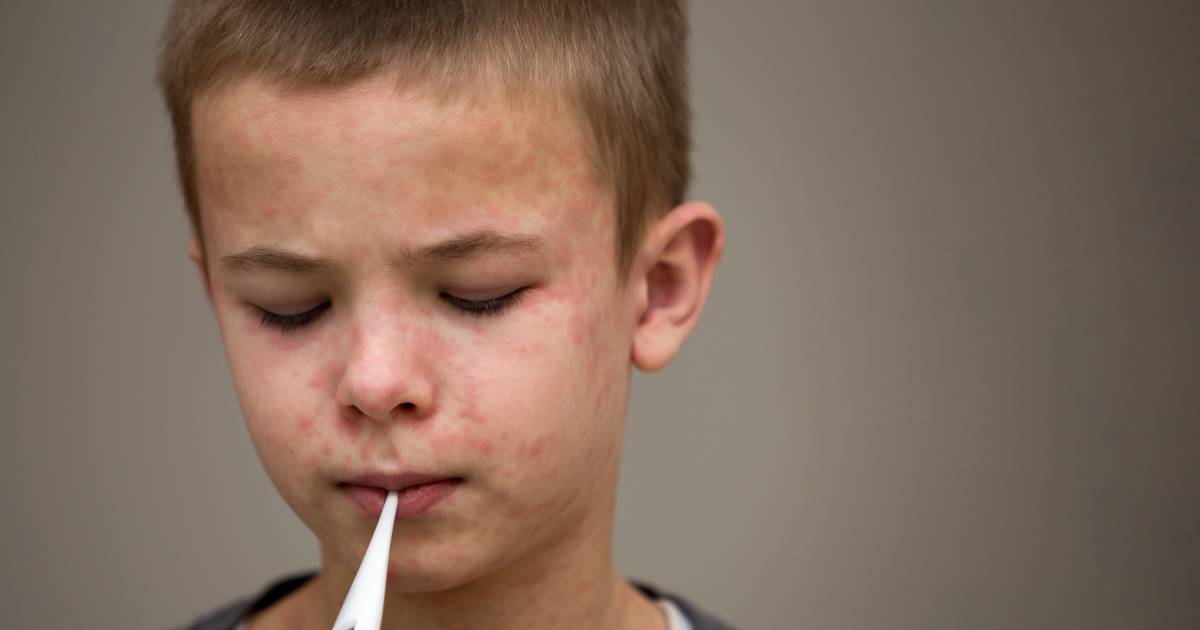 Mazelen gaat rond in Europa, wachten op uitbraak in Nederland: ‘Niet de ...