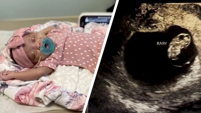 Artsen voeren hersenoperatie uit bij ongeboren baby die lijdt aan ...