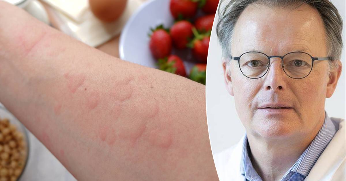 Hoe ontstaat een voedselallergie? En kunnen we die zelf voorkomen? “Ook ...
