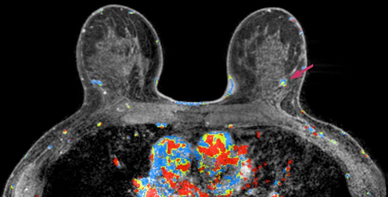 Waarom deze patiënt nu altijd een MRI-scan wil om borstkanker op te sporen