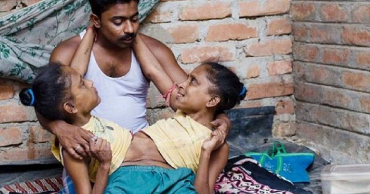 Siamese tweeling vindt liefde bij dezelfde man | Gezond | AD.nl