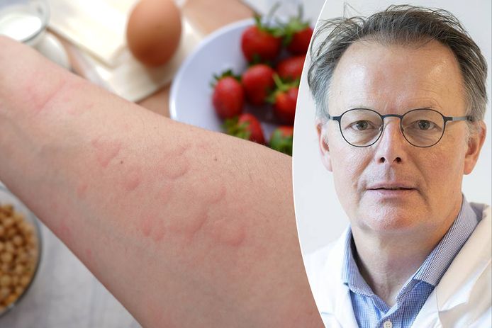 Hoe ontstaat een voedselallergie? En kunnen we die zelf voorkomen? “Ook ...