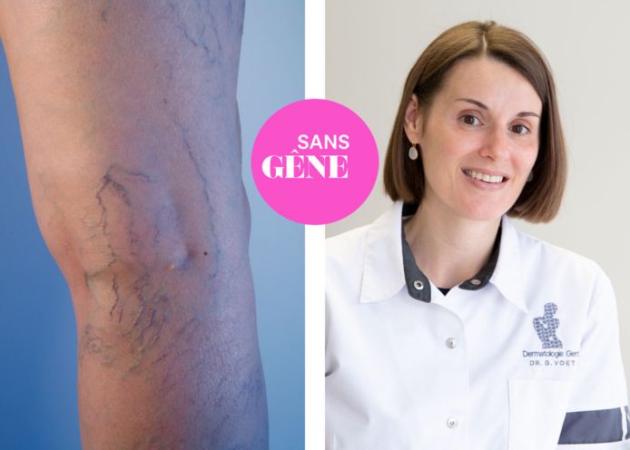 “Het is niet fijn om je benen te tonen.” Marthe (23) heeft spataders ...