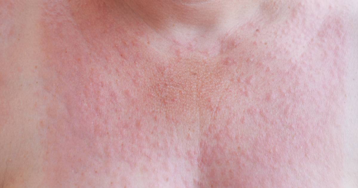 Rode vlekken en jeukende bultjes als je in de zon bent geweest: zo ...