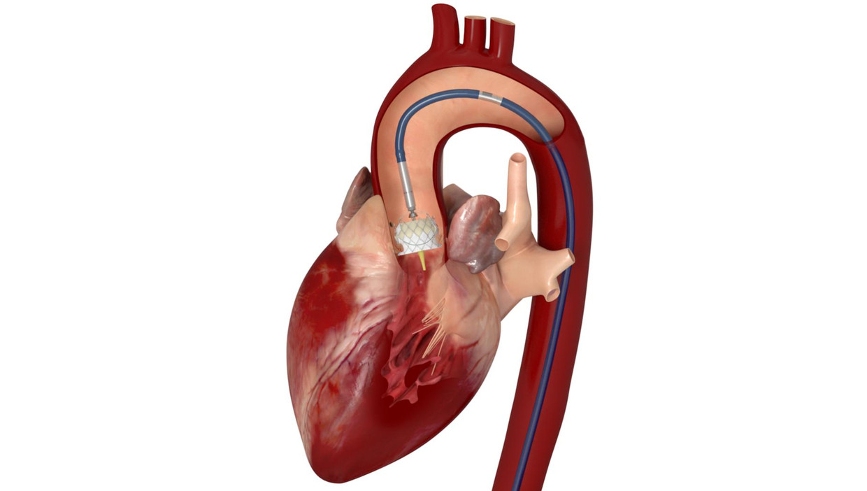 AMC plaatst eerste gemotoriseerde hartkleppen | Het Parool