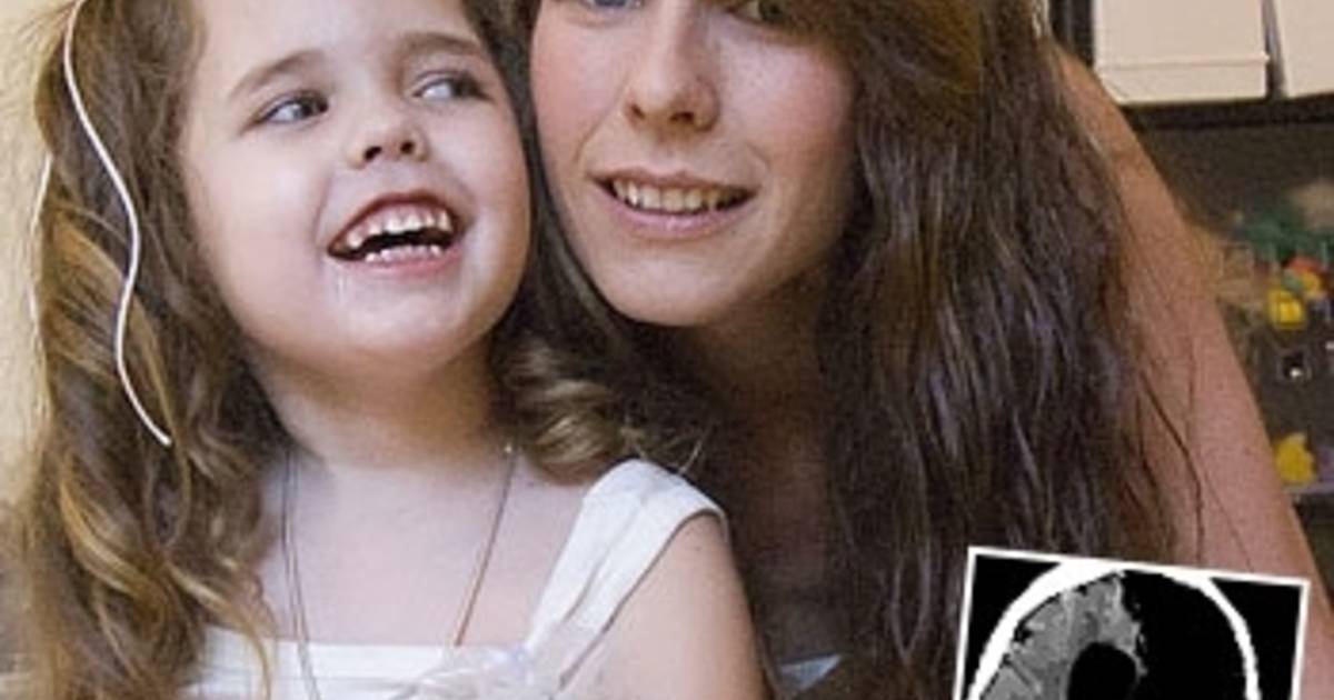 Moedig kind overleeft miraculeus met helft hersenen | Buitenland | hln.be