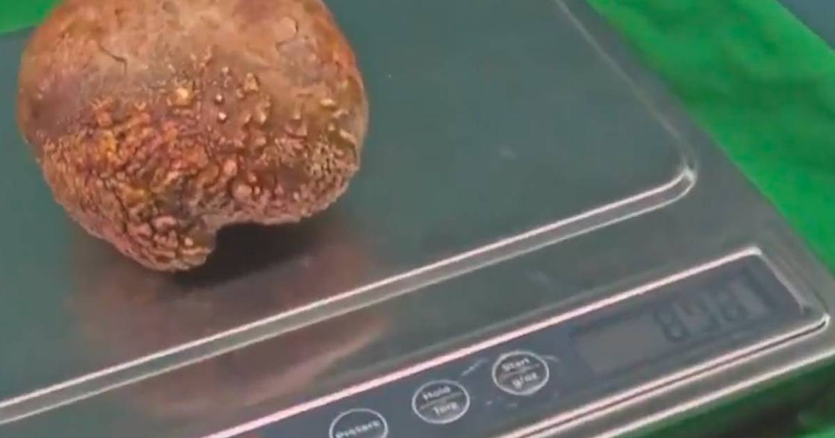 Video van de dag: Grootste niersteen ooit van ruim 13 centimeter ...