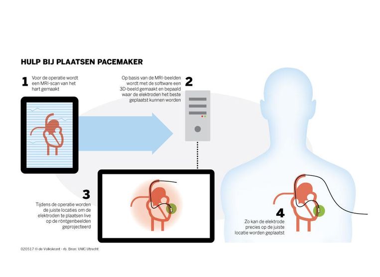 3D-techniek moet plaatsen pacemaker vergemakkelijken | De Volkskrant