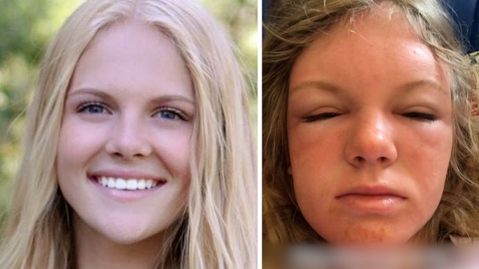 KIJK. Dutje op strand eindigt in wekenlange lijdensweg: Isabela ...