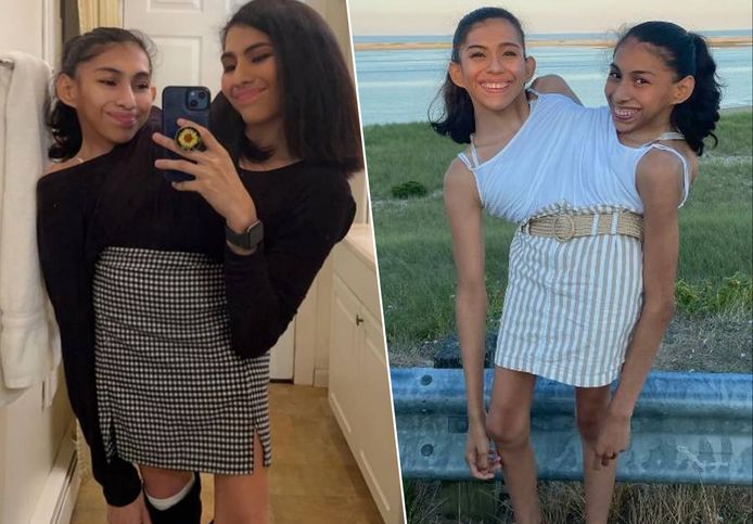Carmen en Lupita (22) zijn Siamese tweeling: “Slechts een van ons heeft ...