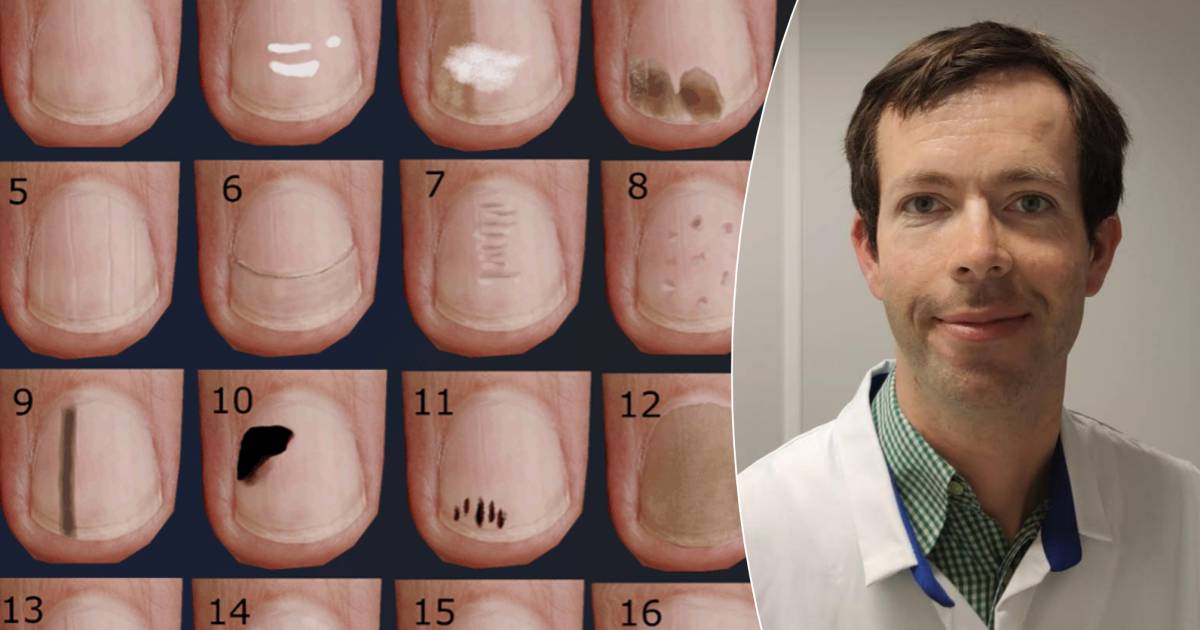 Ce que les taches et fissures sur vos ongles révèlent de votre santé ...