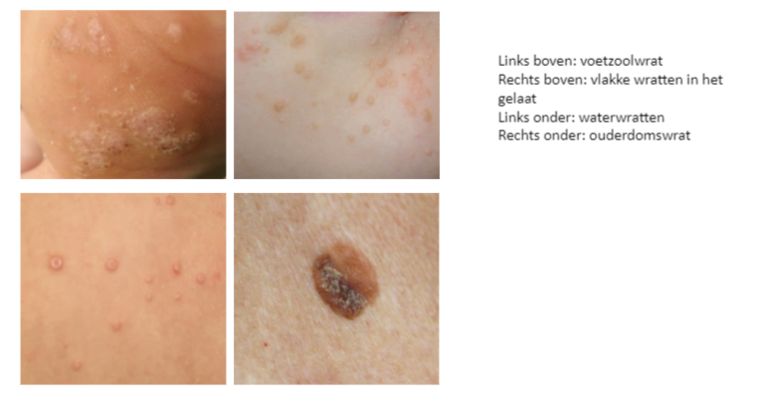 Zo vermijd je wratten, of raak je er weer van verlost: ‘Voorkom wondjes ...