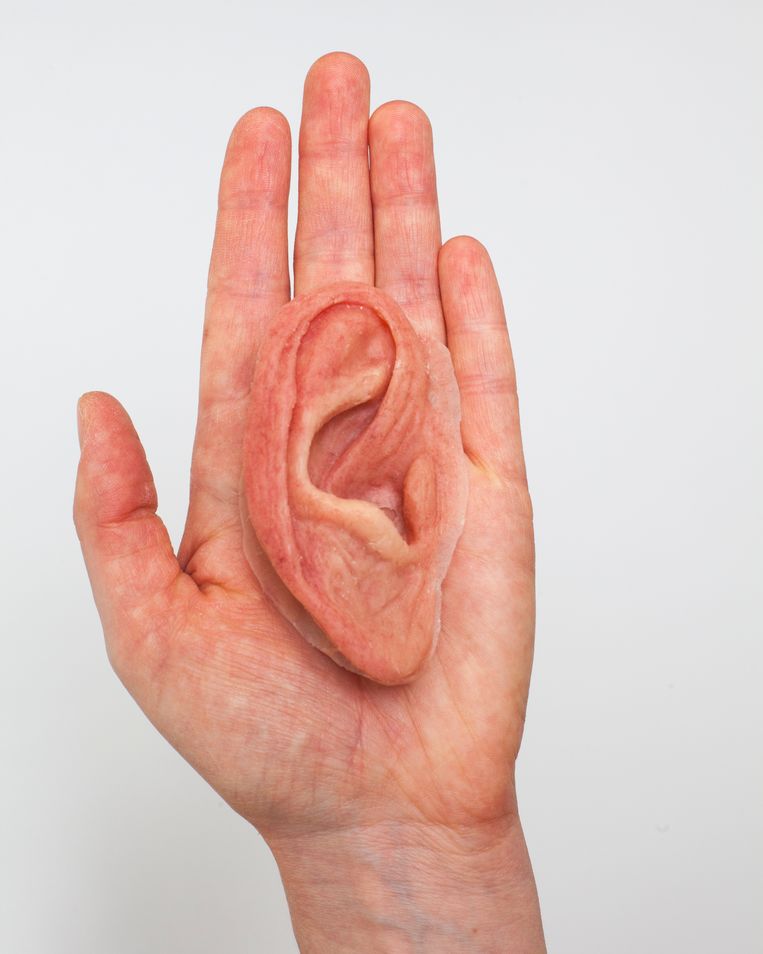 Een net echte neus, oor of oog: hoe patiënten hun gezicht weer terugkrijgen