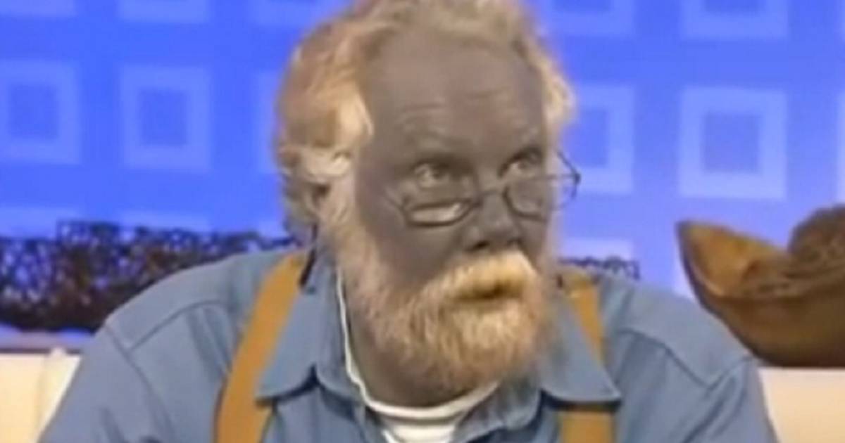 Man met blauwe huid (62) overleden na hartaanval | Bizar | AD.nl