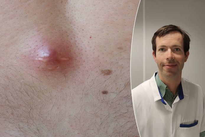 “Sommige producten verhogen de kans op een steenpuist”: zo herken en ...