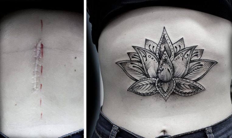 Tatoeëerder maakt gratis tatoeages van littekens van vrouwen