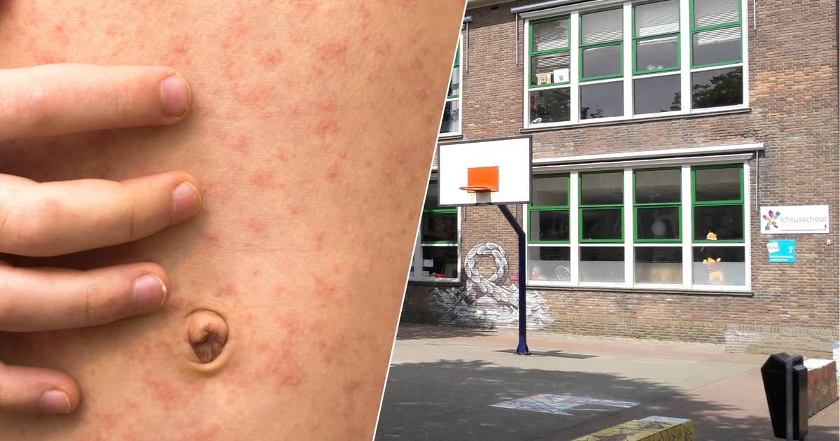 Mazelenvirus duikt mogelijk op in Vlissingen, school vraagt ouders ...