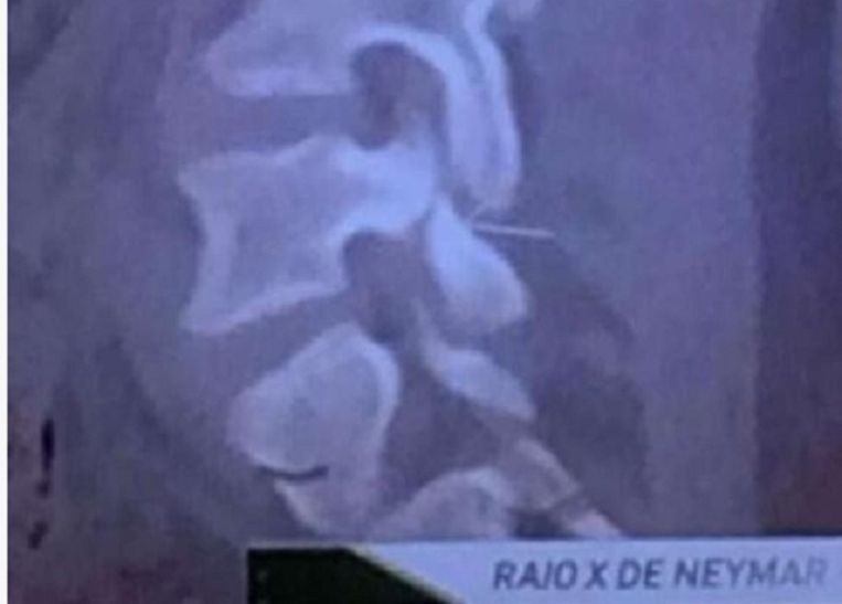 Röntgenfoto gebroken ruggenwervel Neymar gaat de wereld rond