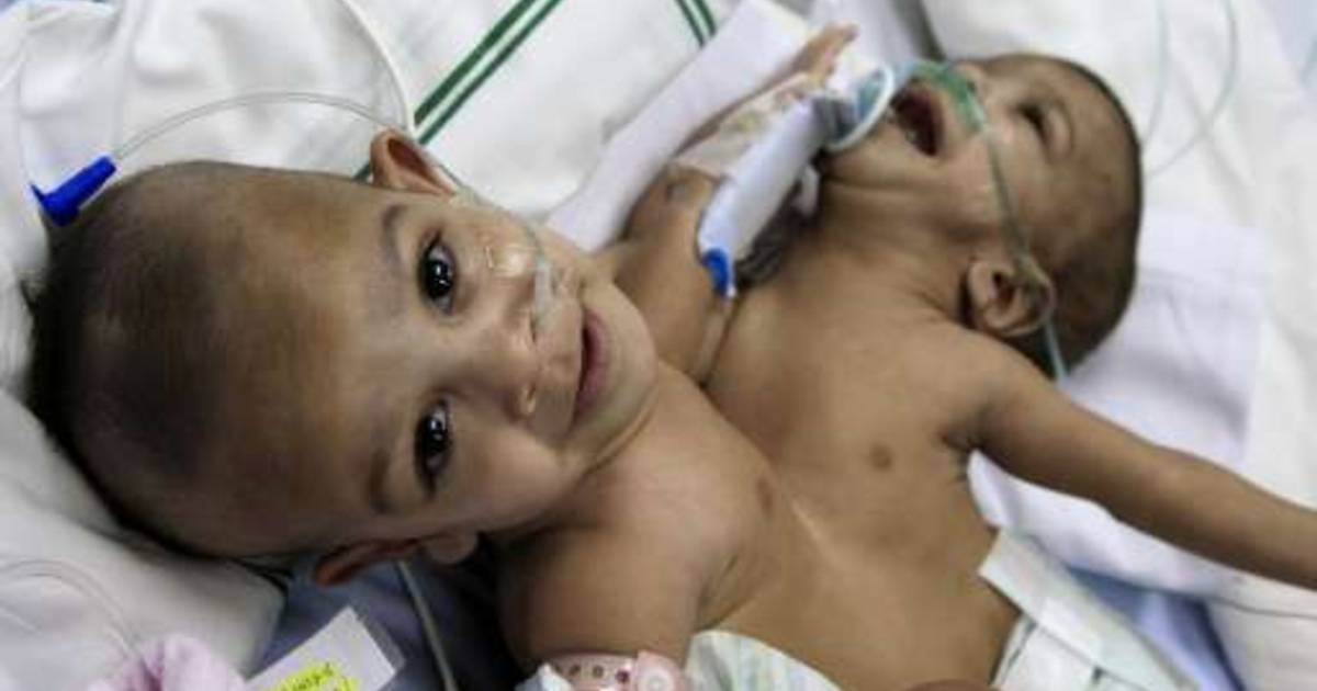 Iraakse Siamese tweeling met succes gescheiden | Buitenland | hln.be