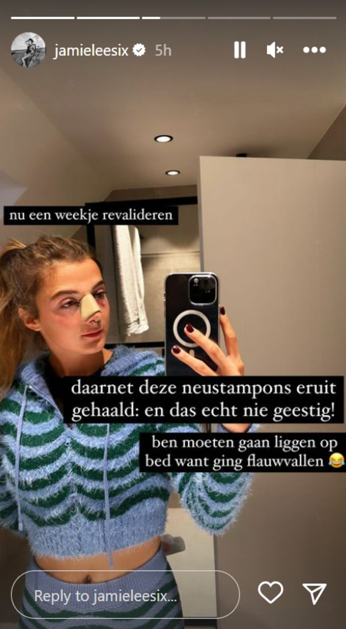 Jamie-Lee Six moest onder het mes: “Kon niet goed ademhalen door mijn ...