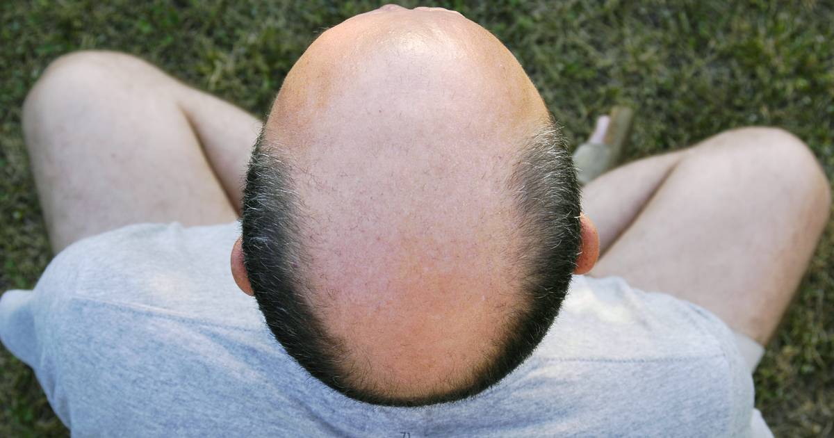 Dit is waarom mannen kaal worden | Gezond | AD.nl