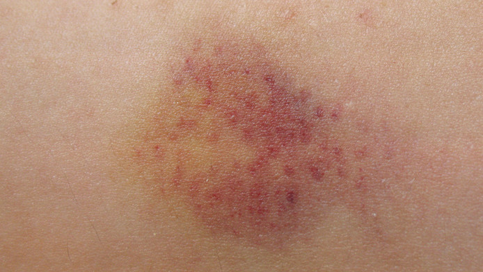 Duits Hooggerechtshof buigt zich over zuigzoen van puber | Buitenland ...