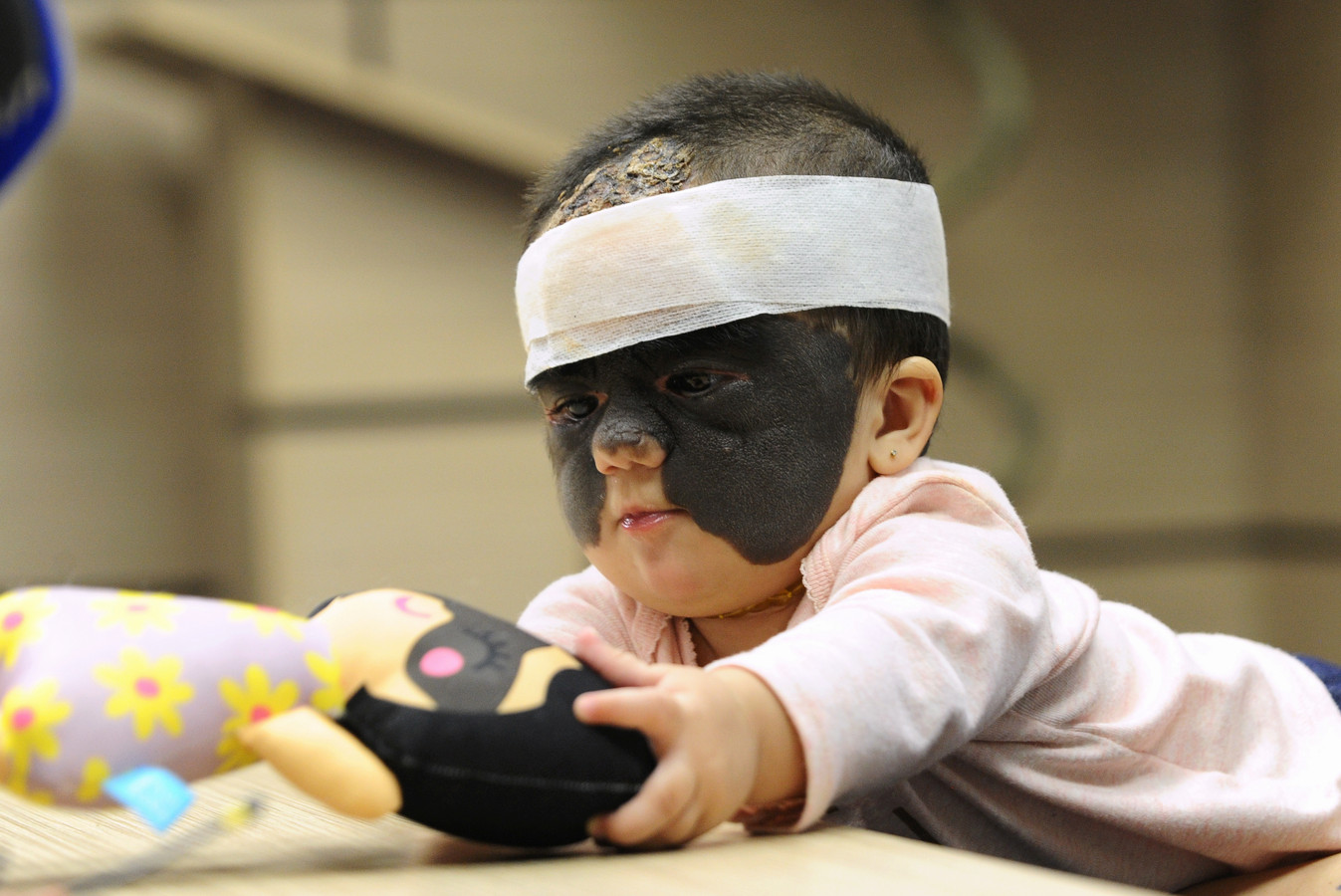 Luna est surnommée “bébé Batman” en raison d'une maladie rare de la ...