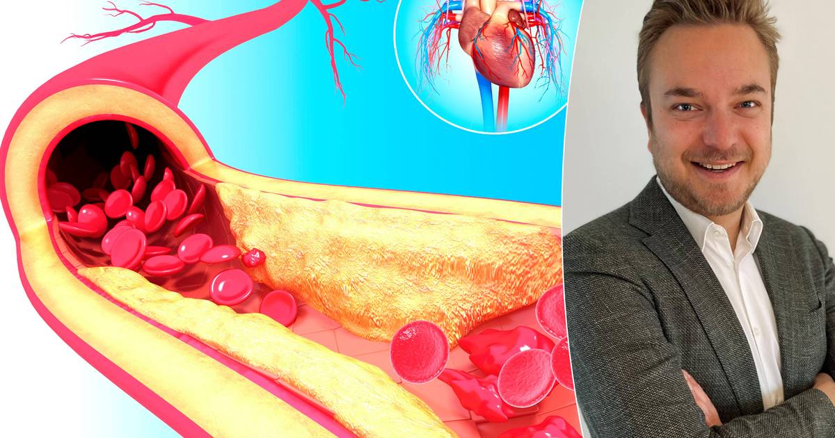 Cardiologen vragen verplichte screening slagaderverkalking: “Meer doden ...