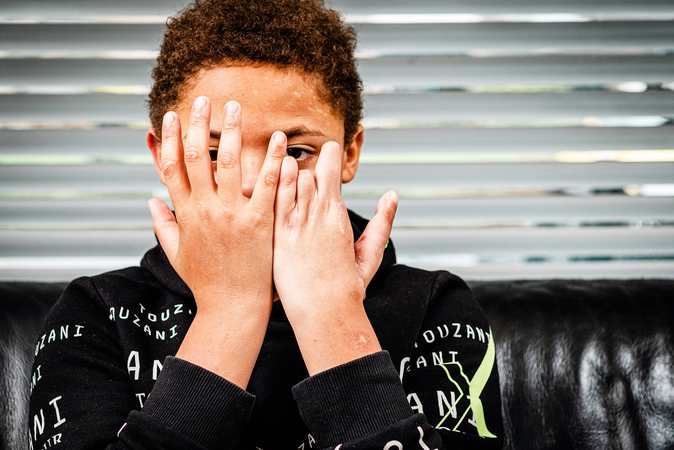 Tristan (12) raakte vingers kwijt toen Cobra explodeerde in zijn hand ...