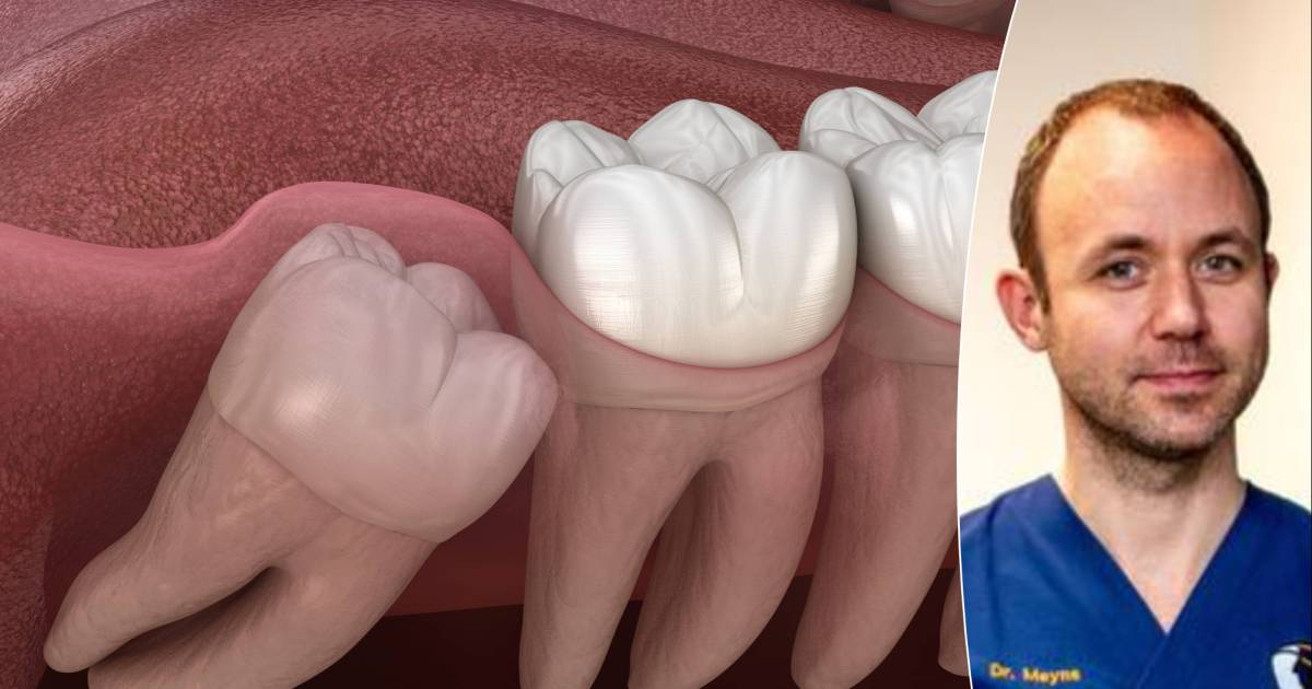 Wanneer moet je je wijsheidstanden laten trekken? “Hoe ouder je bent ...