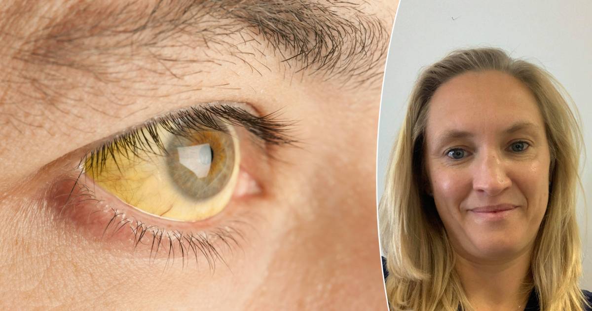 Van galstenen tot alcohol: arts zet mogelijke oorzaken van geelzucht op ...