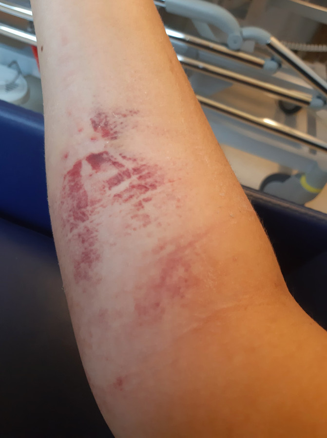 Atteinte d’hyperémèse gravidique, Sharone vomissait jusqu’à 80 fois par ...