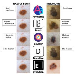Trois sortes de cancers de la peau et comment les reconnaître: “Les ...