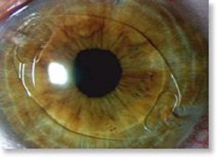 Nieuwe kunstlens verhelpt staar en bijziendheid | De Morgen