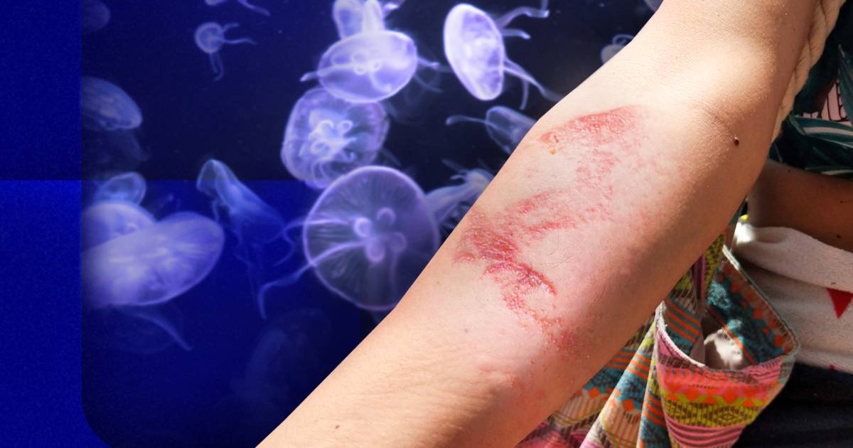 Spoedarts legt uit wat te doen bij kwallenbeet: “Ik raad mensen af om ...