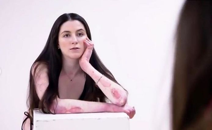 Studente met zeldzame huidaandoening staat model voor Vogue: “Ik ben ...