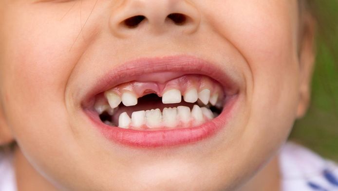Gebit allochtoon kind telt opvallend veel gaatjes | Rotterdam | AD.nl