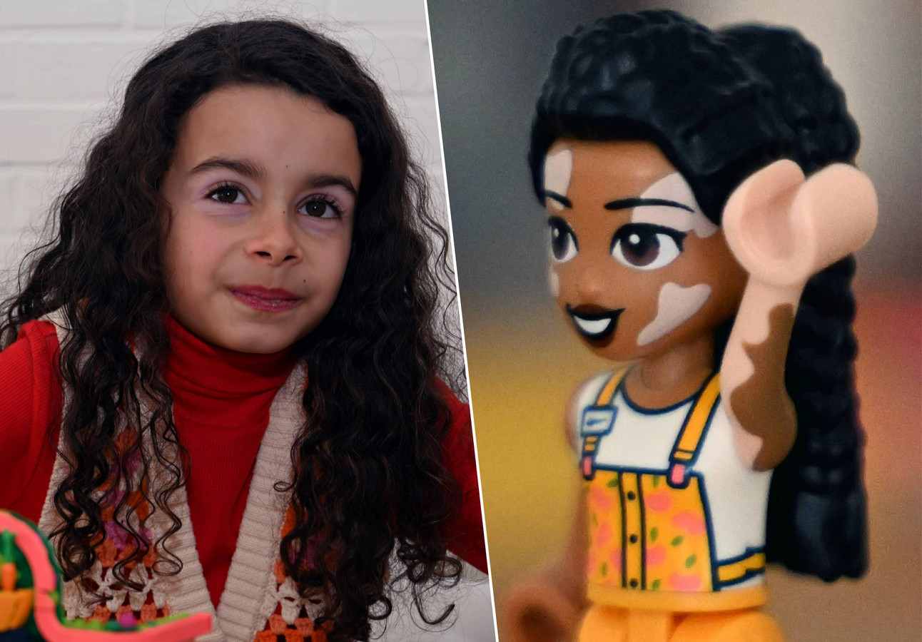 "Maman, regarde... C'est moi!": atteinte de vitiligo, Emily est devenue ...