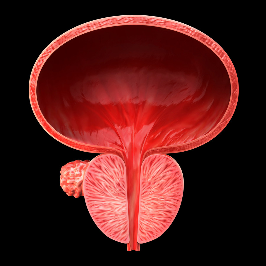 Vroege opsporing prostaatkanker belangrijk: hier moet je alert op zijn ...