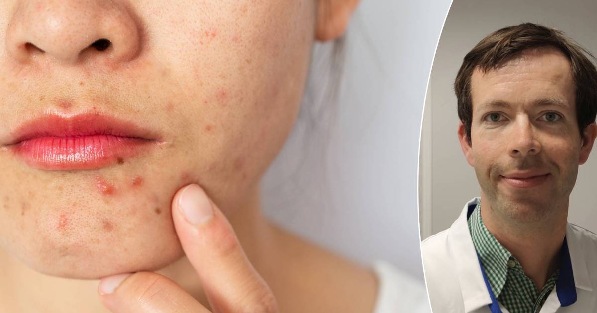 Waarom krijgen ook volwassenen puistjes en hoe bestrijd je die ...