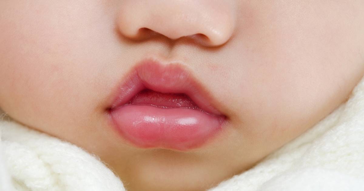 Succesvolle ingreep hazenlip ontdekt | Familie | hln.be