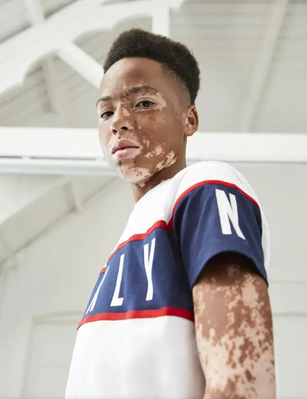 Love Islander Gideon openhartig over zijn huidaandoening: “Het leven ...