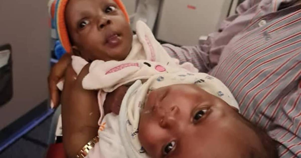 Siamese tweeling uit Congo met succes gescheiden in Kinderziekenhuis ...