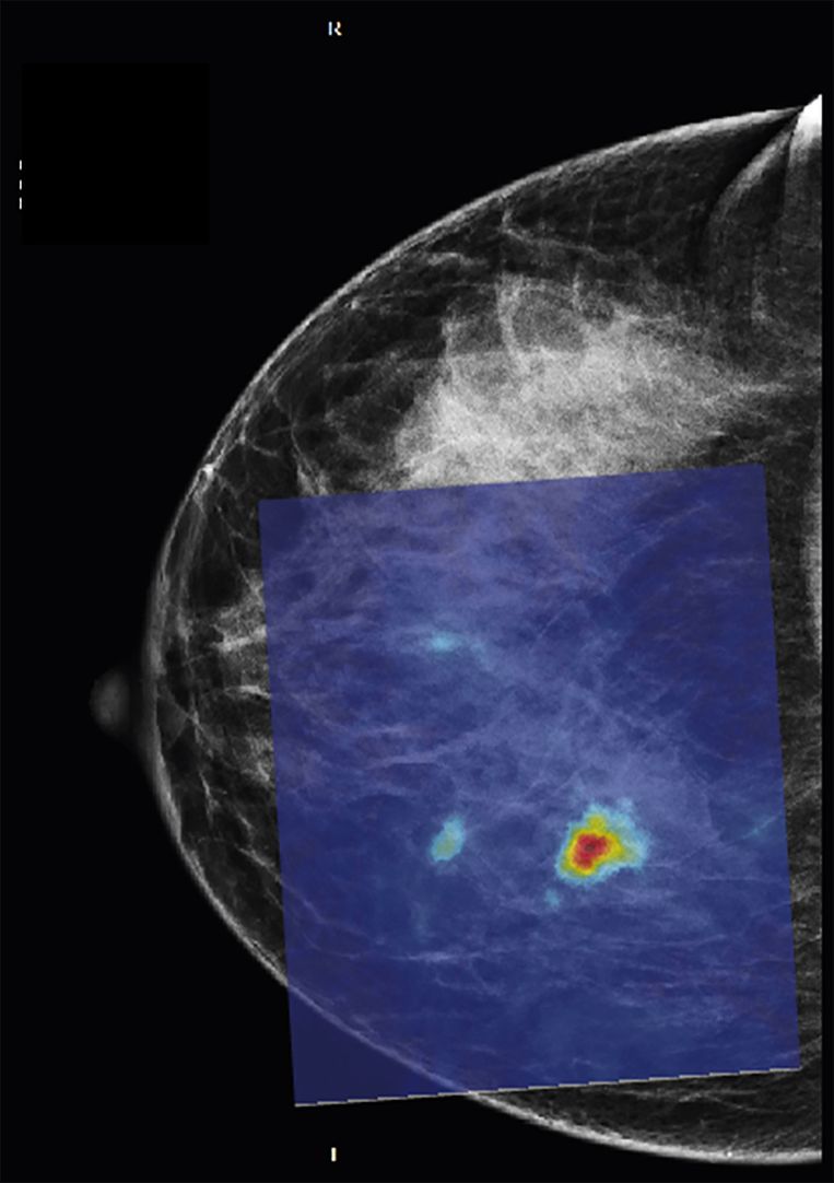Redt preventieve screening op borstkanker levens? | De Volkskrant