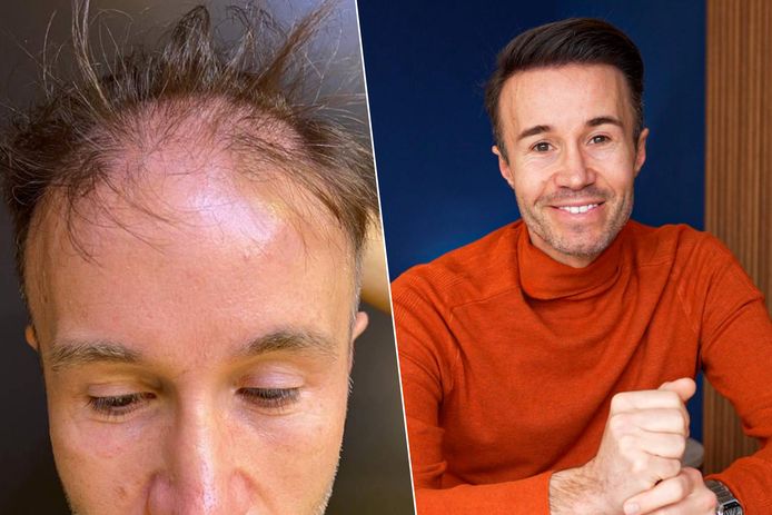 Ivann Vermeer maakt podcast over haarverlies: "Zonder oplossing ging ...