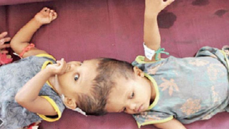 Siamese tweeling succesvol gescheiden na lange operatie in India ...